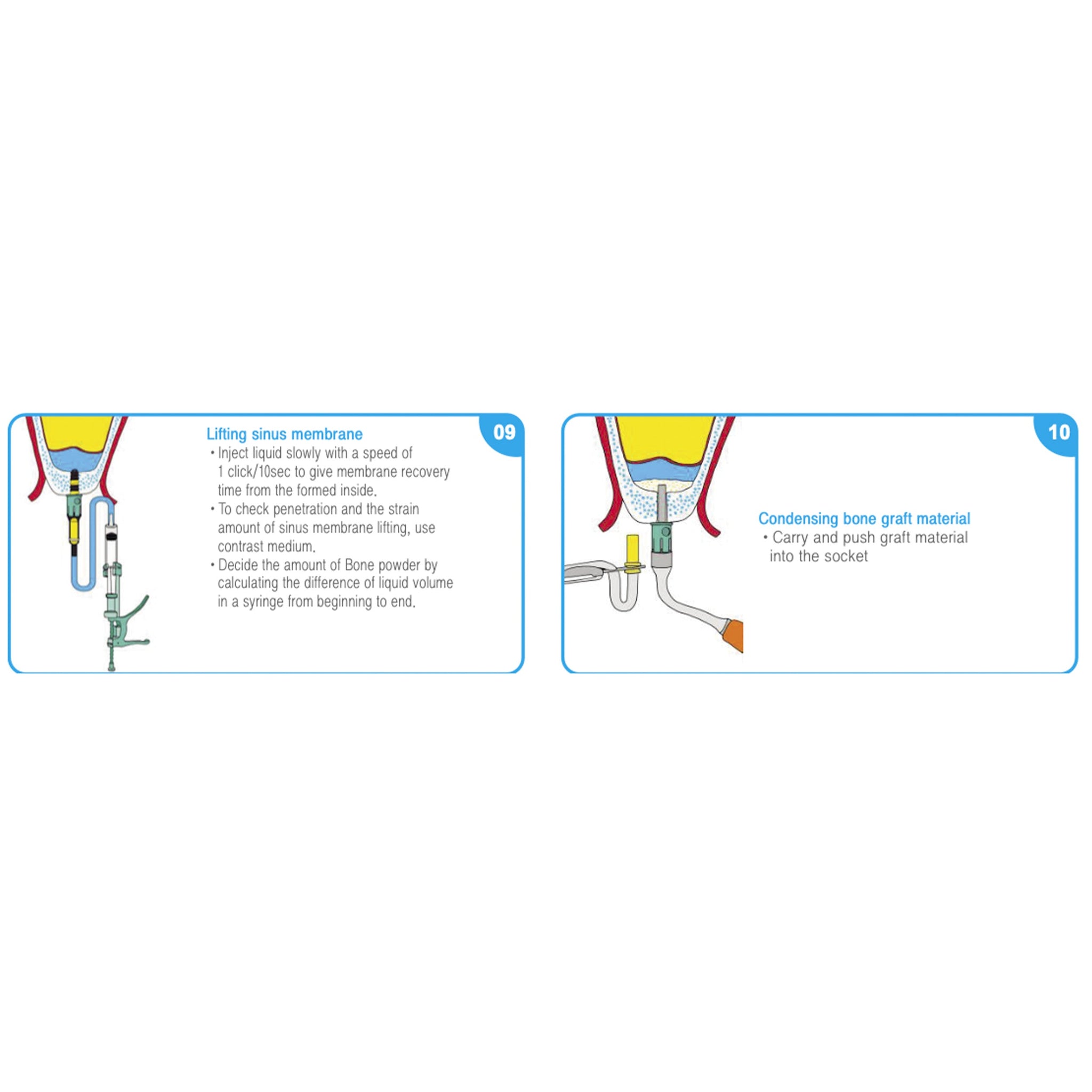 Sinus Lift Crestal Approach Kit with Aqua Lift Osung -OCA-KIT | Osung USA